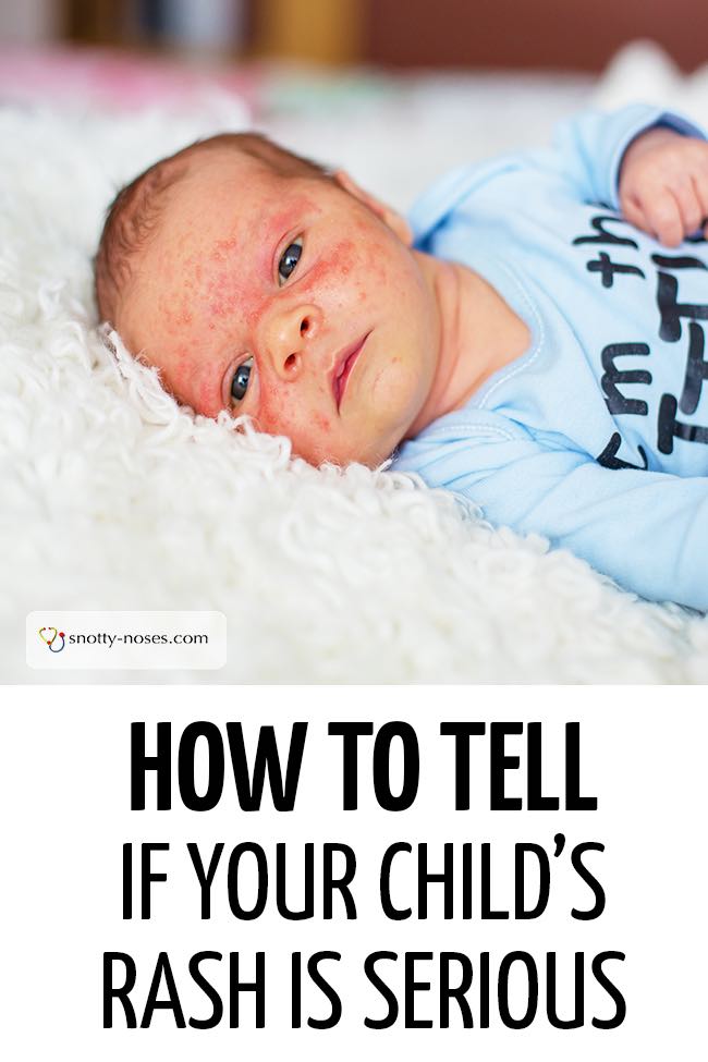 Rashes in children, Snotty Noses